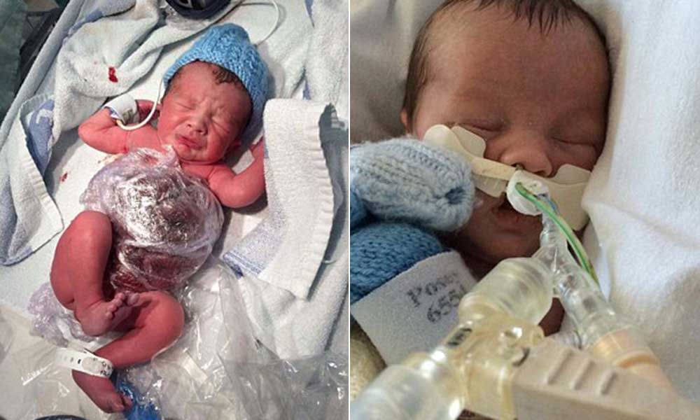 Baby Born With Intestines Out Suffered 9 Operations - दुर्लभ बीमारी के ...