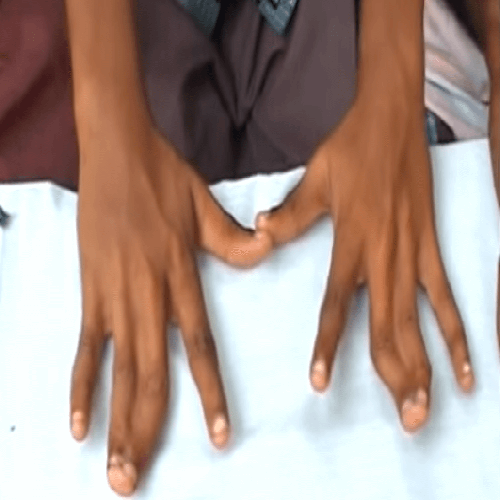 140 Family Members With Webbed Fingers - इस परिवार के 140 सदस्यों की चिपकी हुई है सभी उंगलिया ...