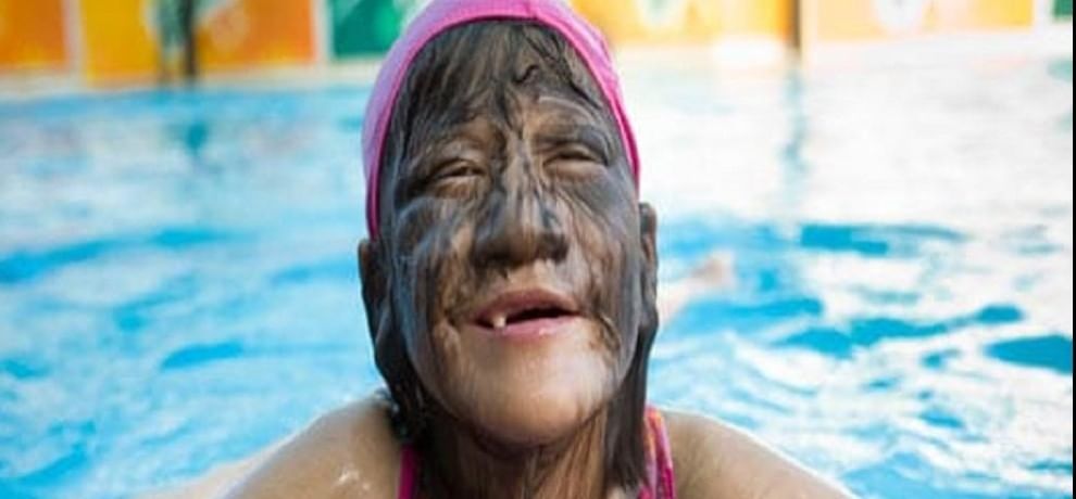 Supatra Sasuphan Is Become Popular Because Of Dangerous Disease - 'बंदर ...