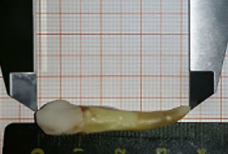 Dentist Pulls Out The Worlds Longest Tooth From A Patient In Germany ...